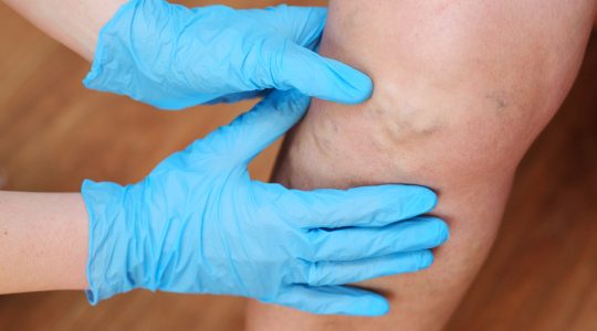 CEAP Classification of Chronic Venous Disorders