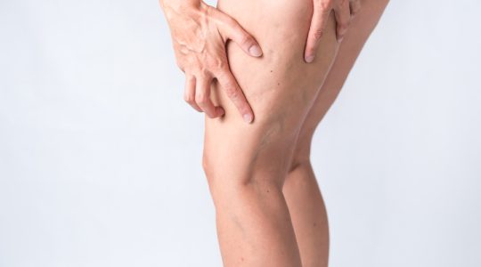 CEAP Classification of Chronic Venous Disorders