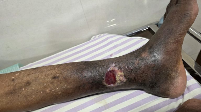 Comprehensive Guide to Venous Ulcers Management