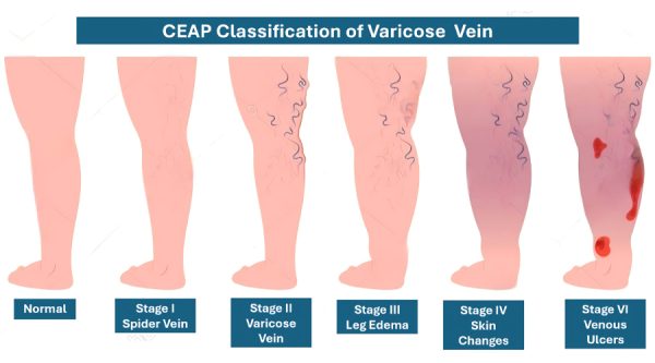 CEAP Classification Of Chronic Venous Disorders CEAP Classification Of Chronic Venous Disorders